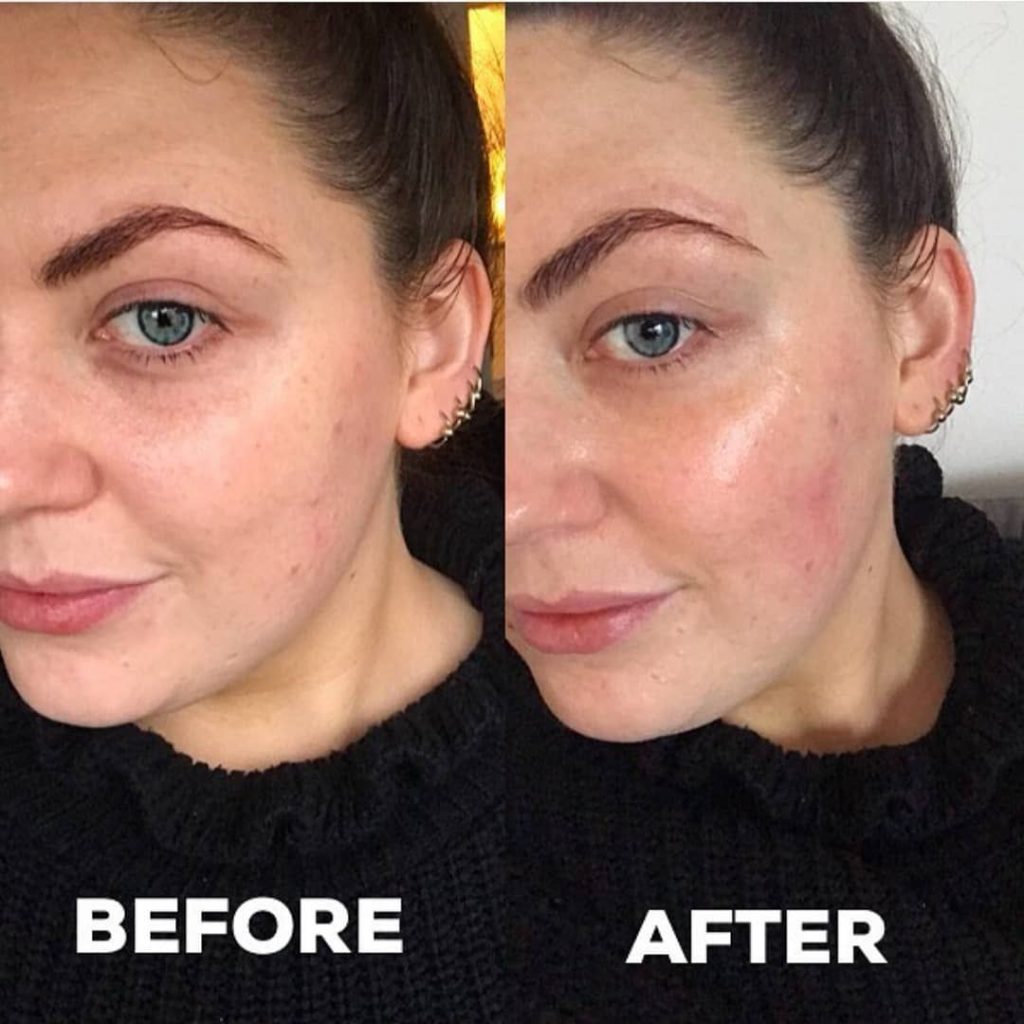 Dermaplaning Before & After: Real Results and Transformations - Chaztin