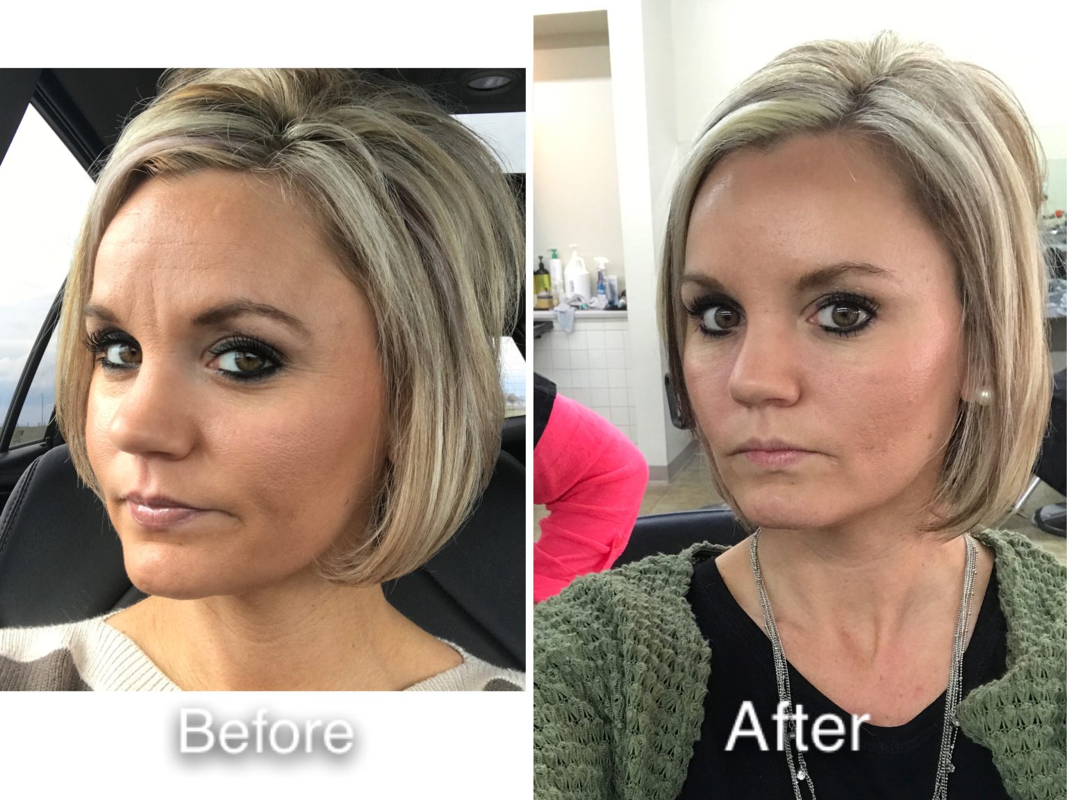 Botox Neck Before and After: Dramatic Results and Real Patient Photos ...