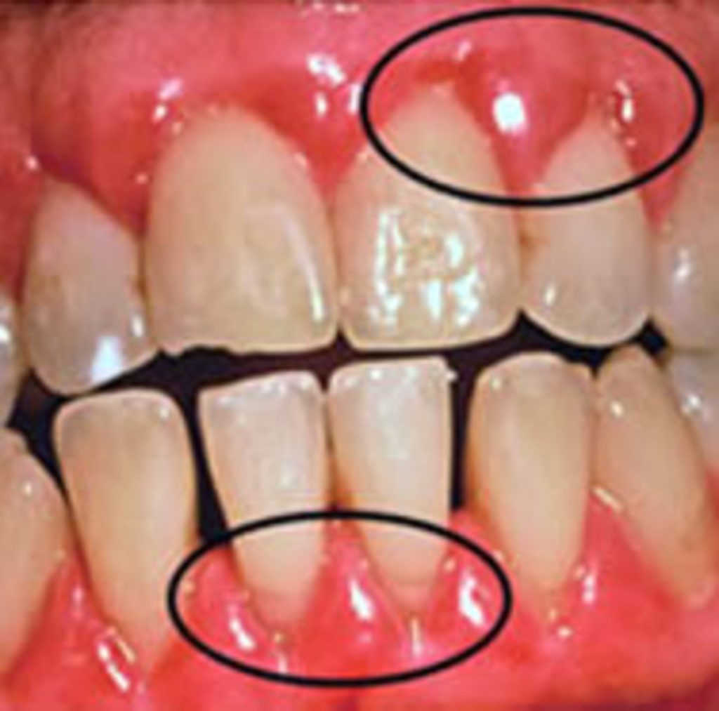 Bruised Gums: Causes, Symptoms, Treatment, and Prevention - Chaztin