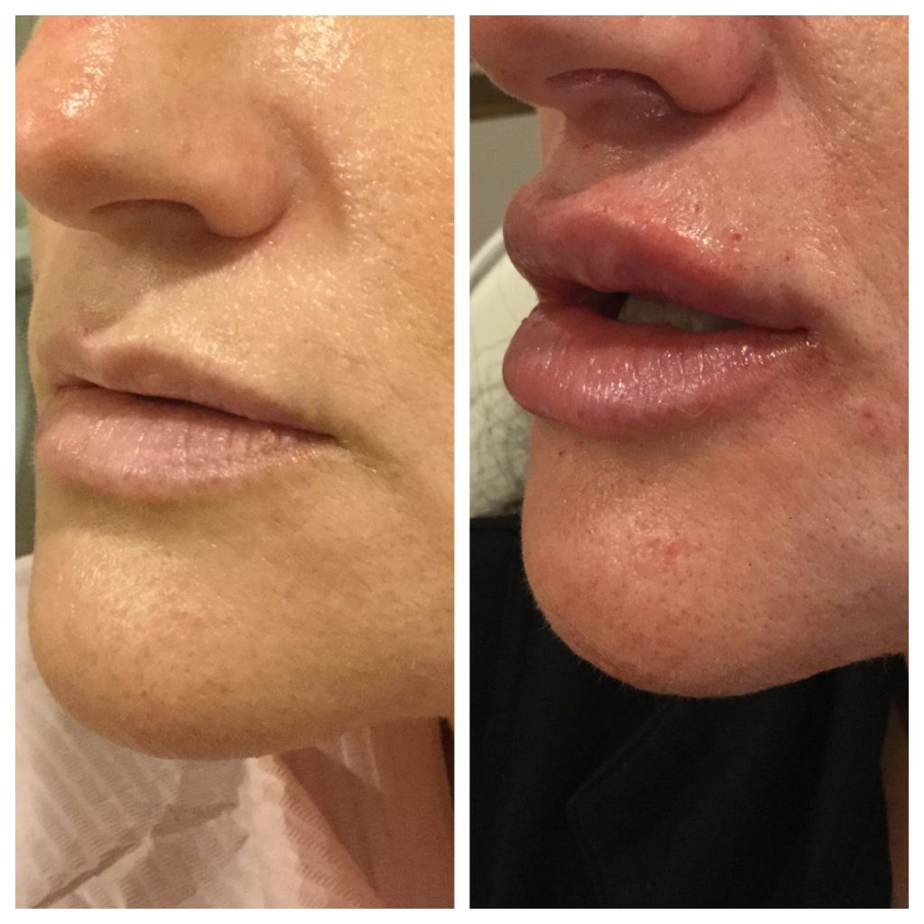 Chin Botox: Dramatic Before & After Transformations – Cost, Results ...