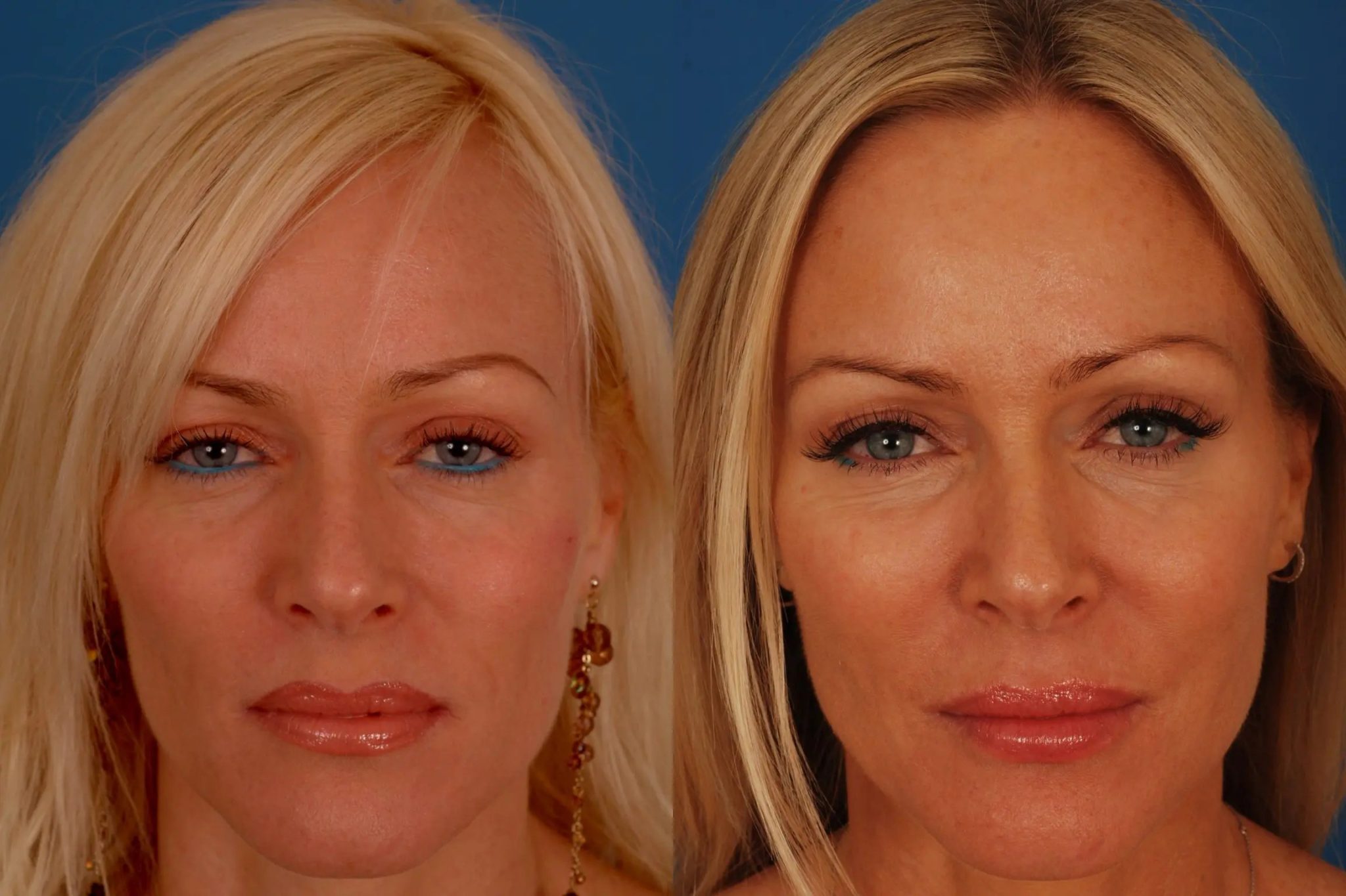 Chin Botox Before & After: Dramatic Transformations and Real Patient ...