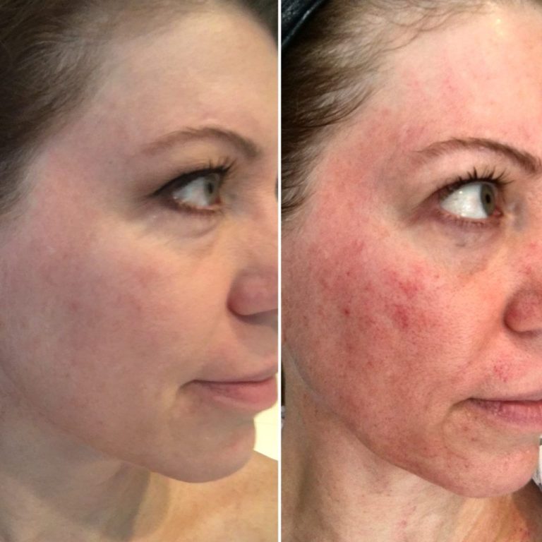 Dermaplaning Before & After: Real Results and Transformations - Chaztin