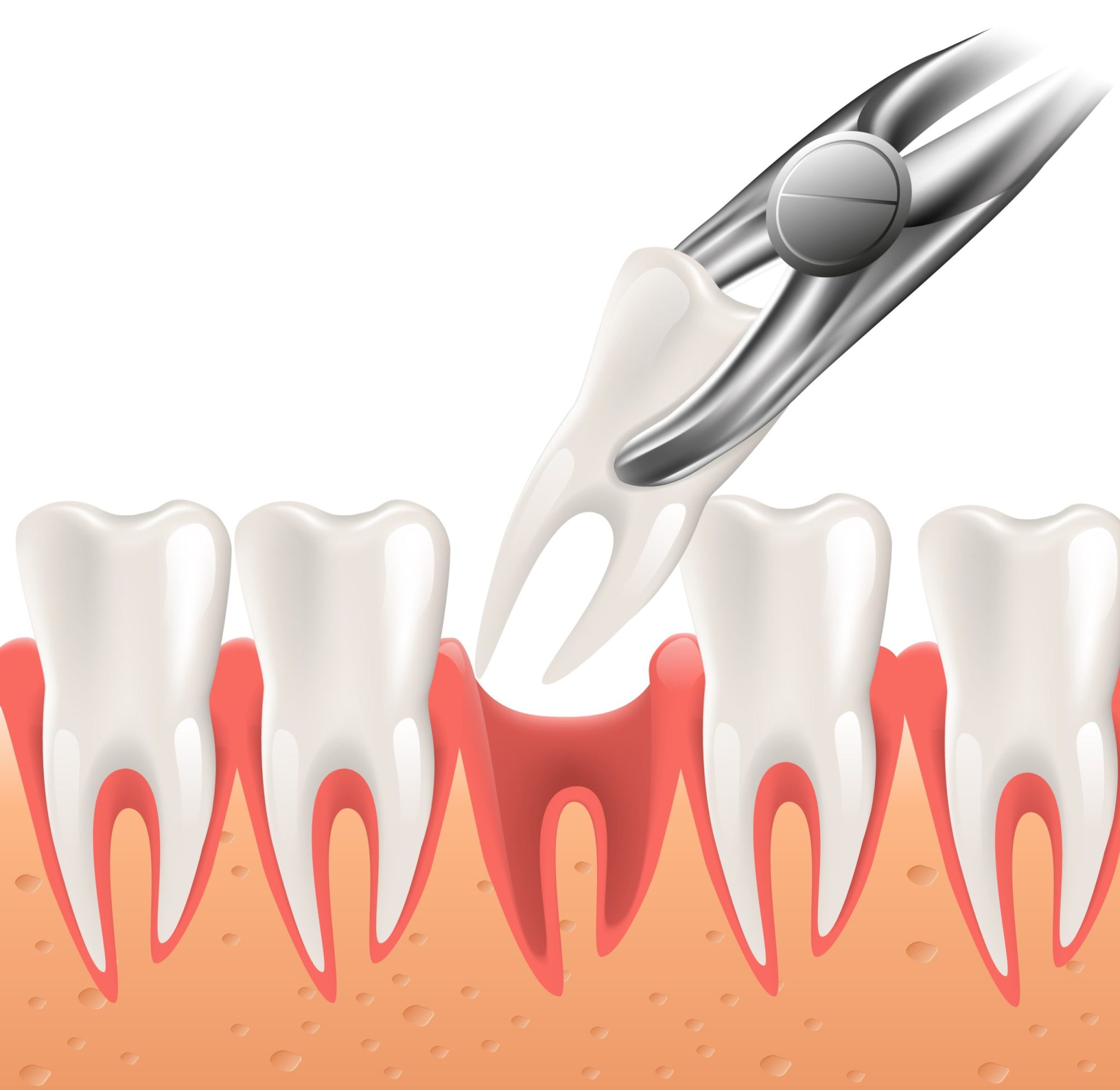 Your First Night After Tooth Extraction: Tips for a Smooth Recovery ...