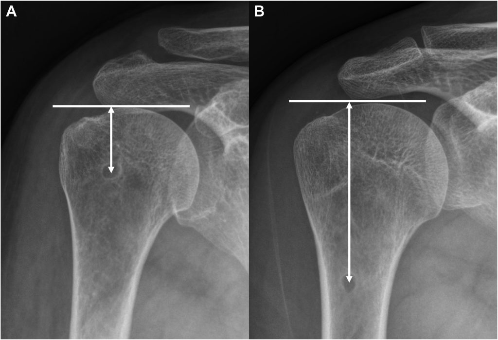 Biceps Tenodesis Rehabilitation Protocol: A Comprehensive Guide to ...
