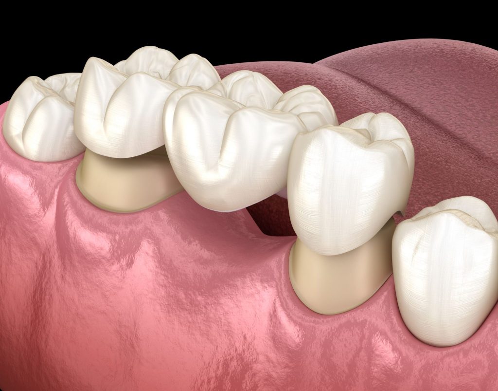 See the Transformation: Bridge Teeth Before & After Photos & Patient ...