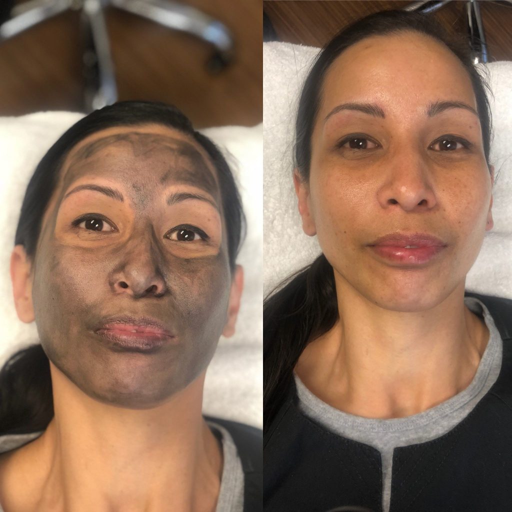 Carbon Laser Peel: Your Complete Guide to Radiant and Rejuvenated Skin ...