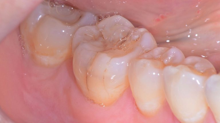 Exposed Tooth Nerve: Causes, Symptoms, Treatments, and Relief - Chaztin