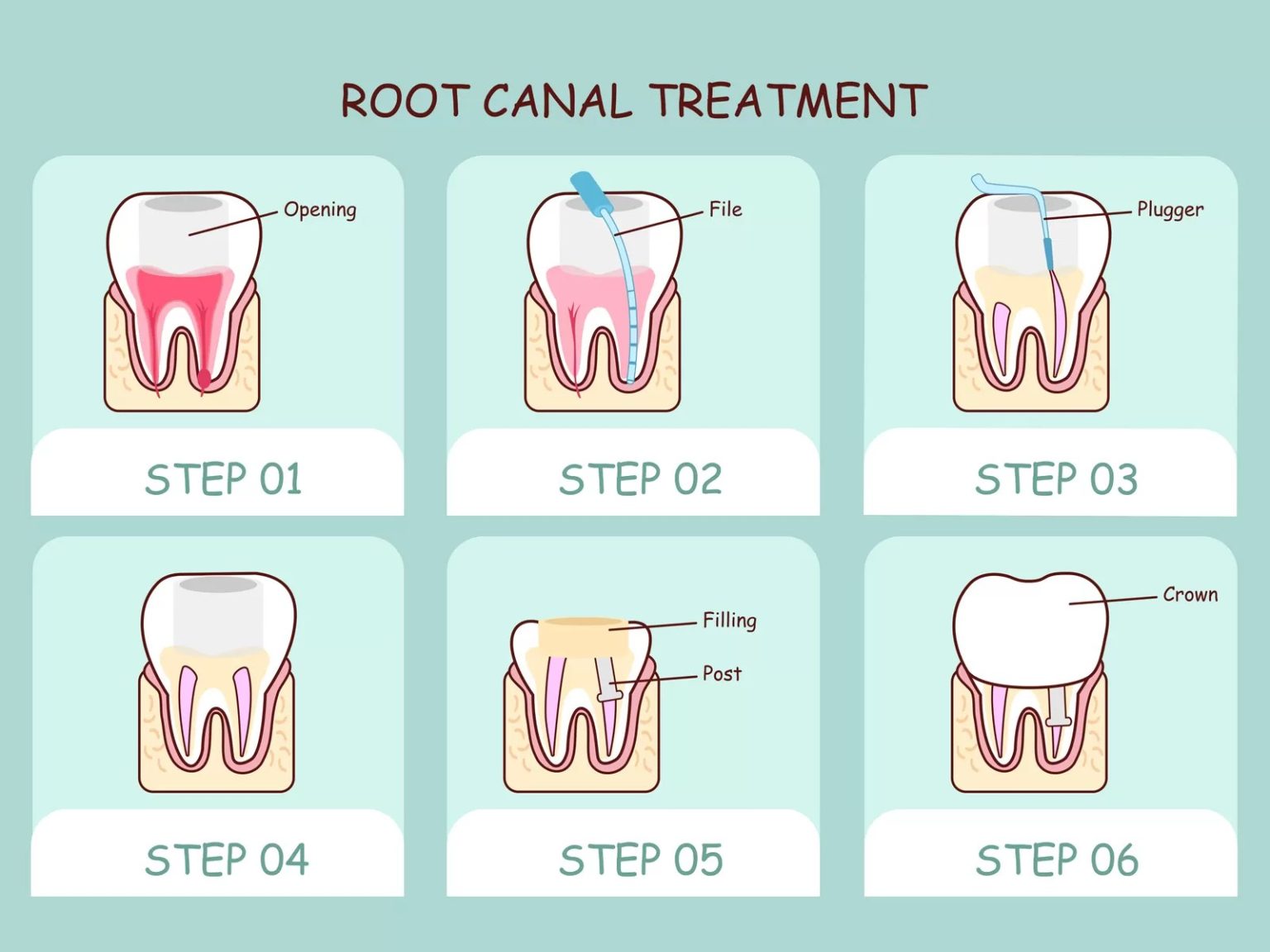 How Long Does a Root Canal Last Without a Crown? - Chaztin