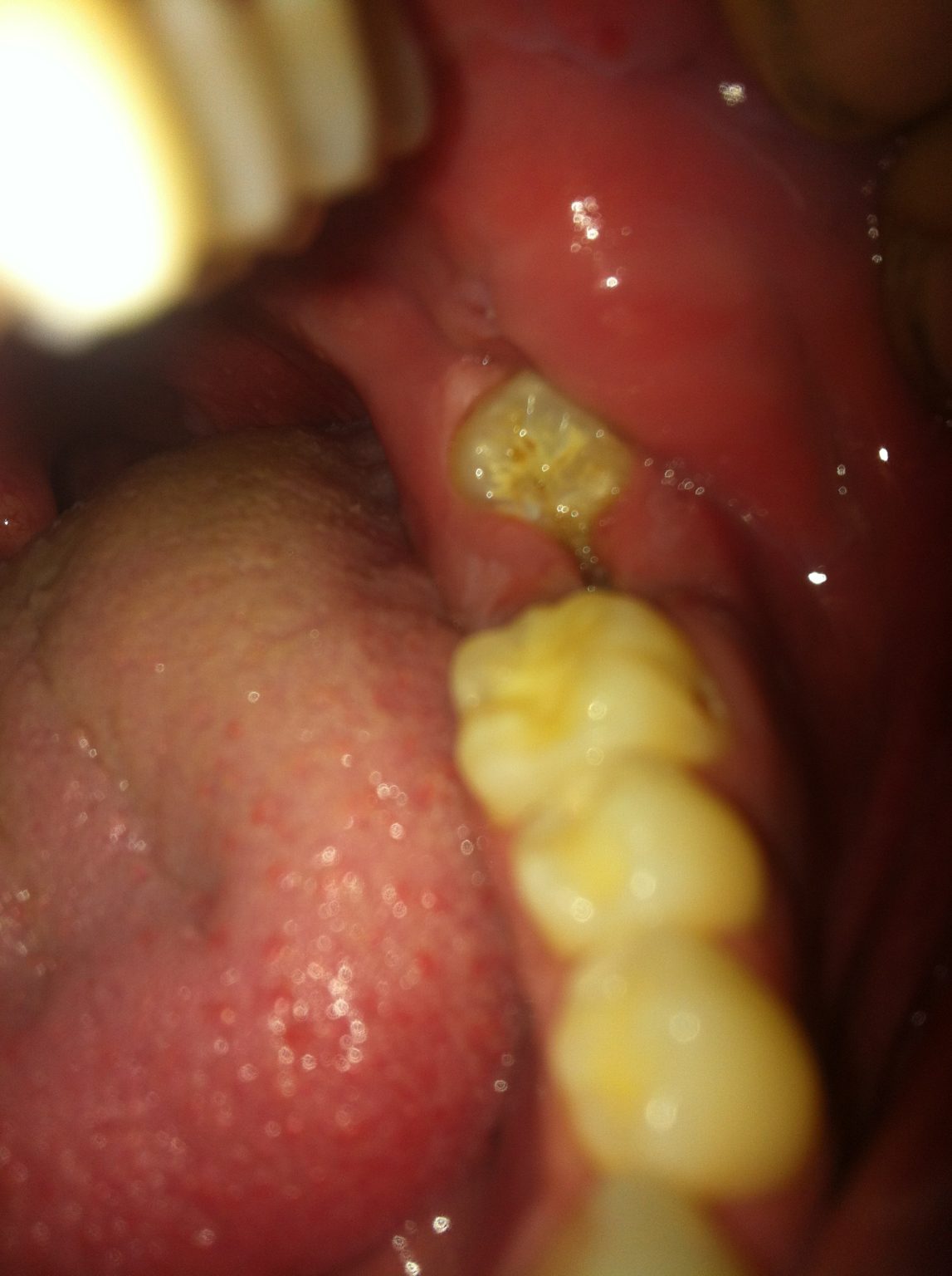 How to Get Food Out of a Wisdom Tooth Hole: Expert Tips for Safe ...