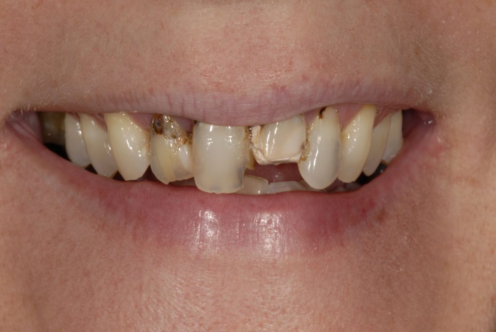 How to Safely Remove a Very Loose Rotten Tooth at Home: DIY Methods ...