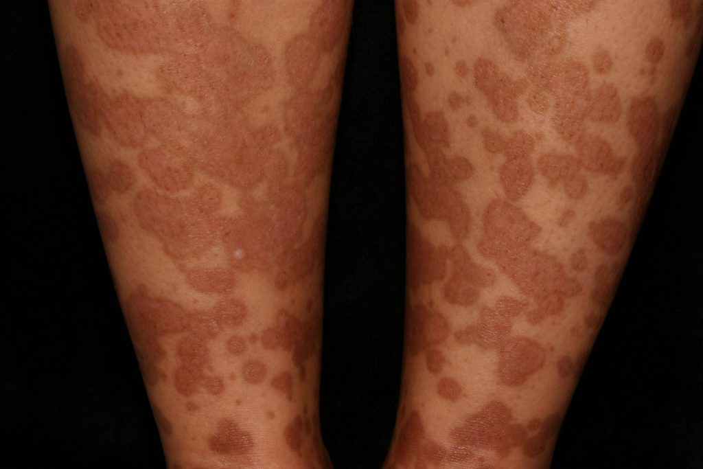 Understanding Hyperpigmentation on Legs: Causes, Treatments, and ...