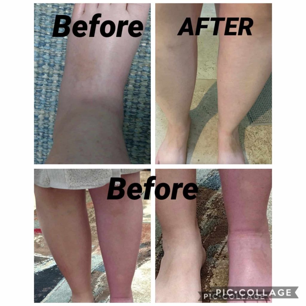 Lymphatic Drainage Massage: Remarkable Before & After Results (Photos ...