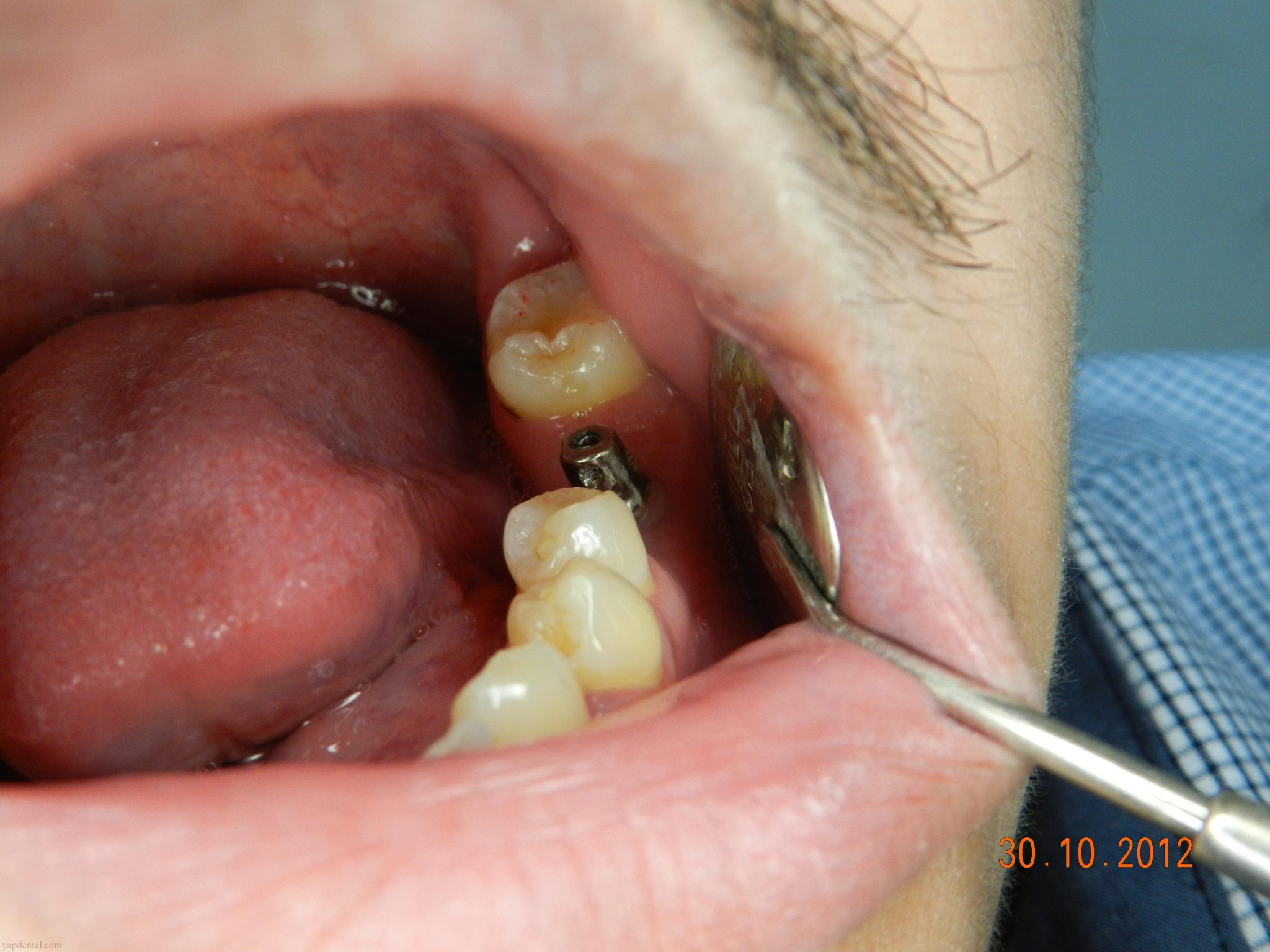 Molar Implants: Your Guide to Costs, Procedures, and Restoring Your ...