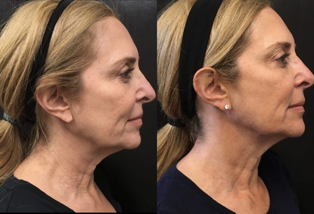 Neck Botox: Your Guide to a Younger, More Defined Neckline - Chaztin