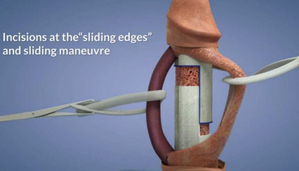 Penile Plastic Surgery: Before & After Photos, Patient Stories, and ...