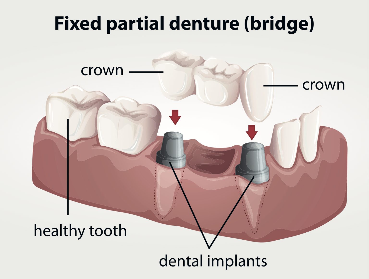 Pontic Tooth: Your Complete Guide to Dental Bridge Replacements - Chaztin