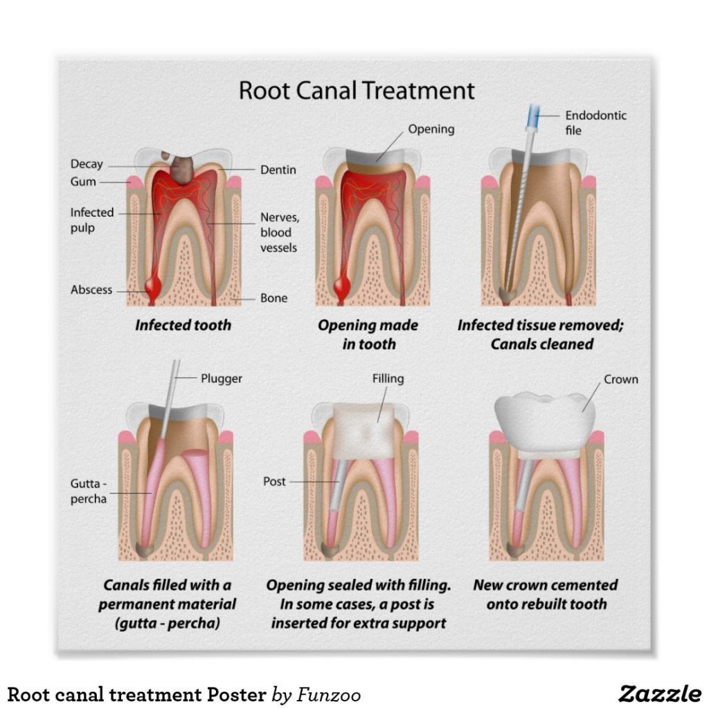 Root Canal Pain Relief: Your Guide to Before, During, and After Treatment - Chaztin