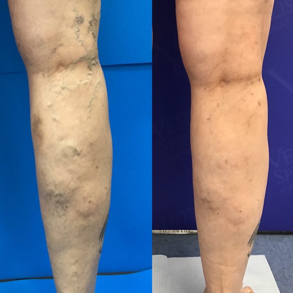 Sclerotherapy Before & After: Your Complete Guide to Vein Treatment ...