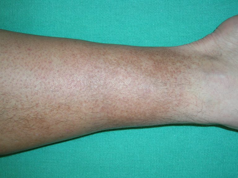 Understanding Skin Discoloration on Legs: Causes, Treatments, and ...