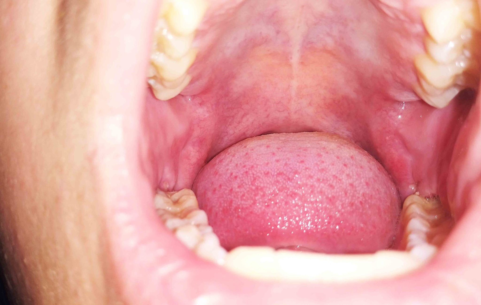 Dissolvable Stitches After Oral Surgery: Everything You Need to Know ...