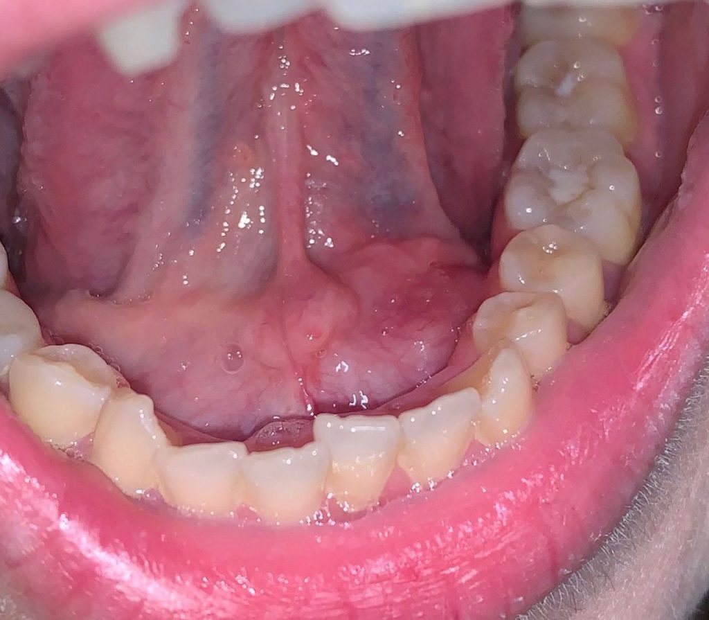 Swollen Roof of Mouth: Causes, Symptoms, Treatment & Home Remedies ...