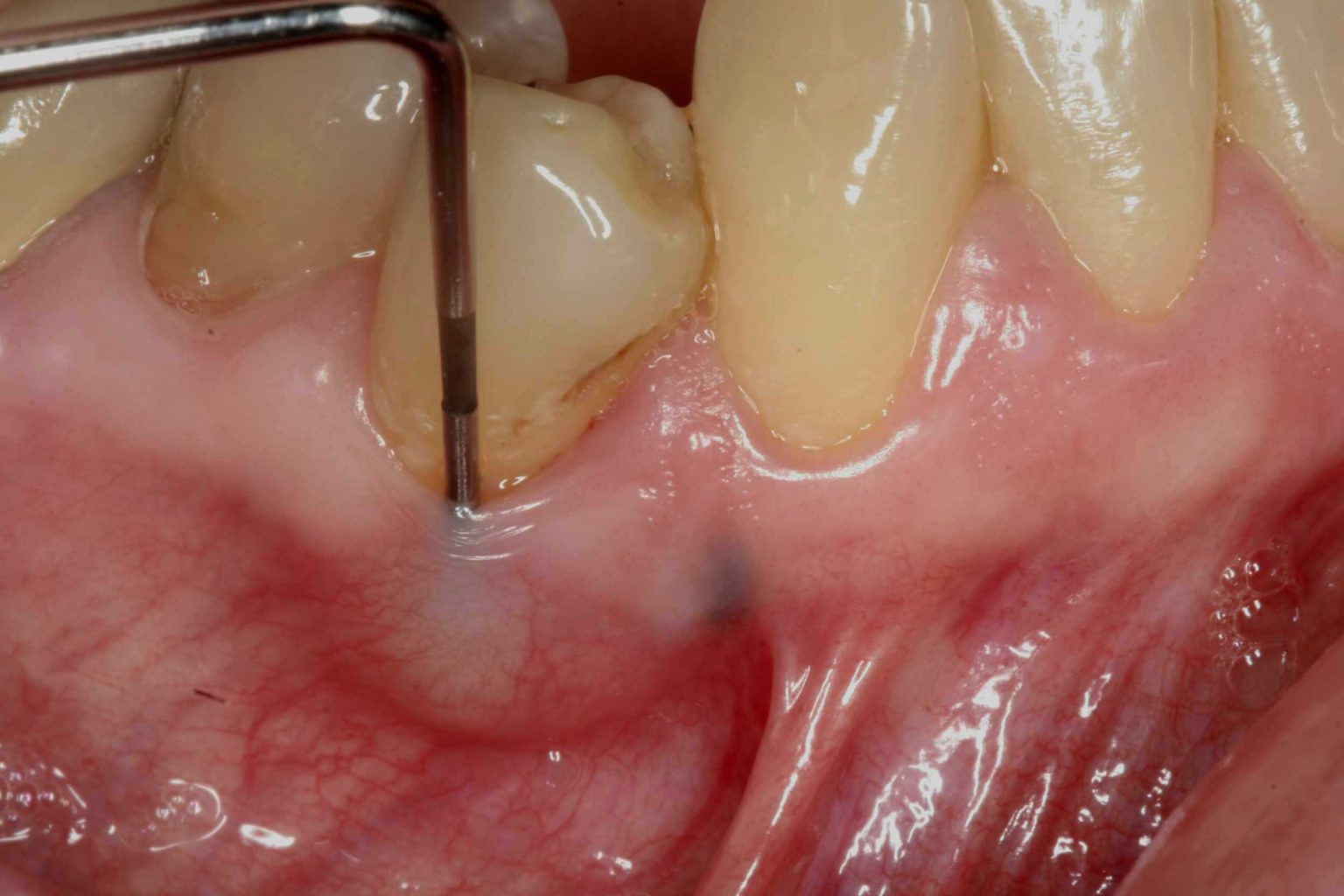 Visual Guide to Tooth Abscess Stages: Pictures, Symptoms, and Treatment ...