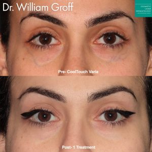 Understanding Under-Eye Veins: Causes, Treatments, and Solutions - Chaztin