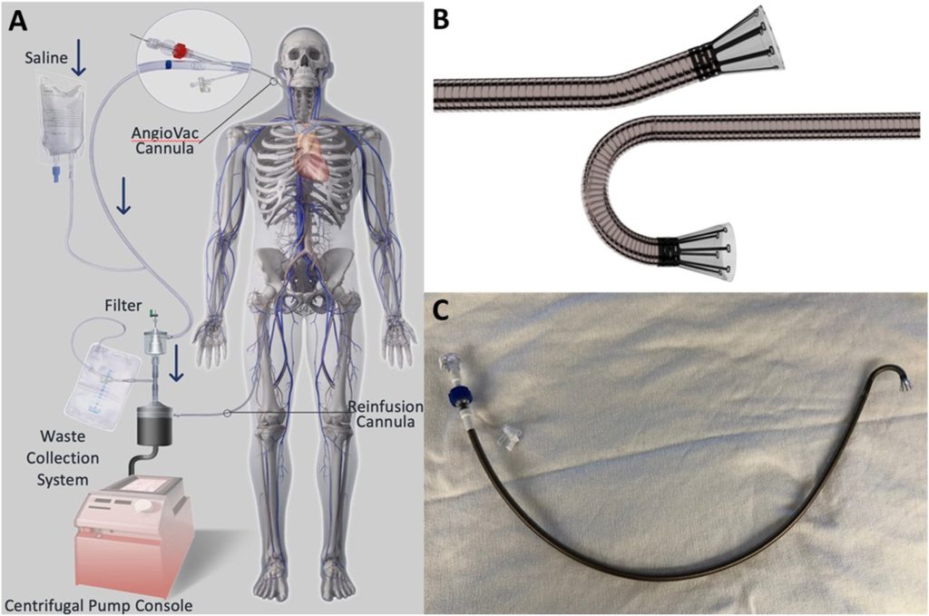 Understanding AngioVac: Procedure, Benefits, Risks, and Finding a ...