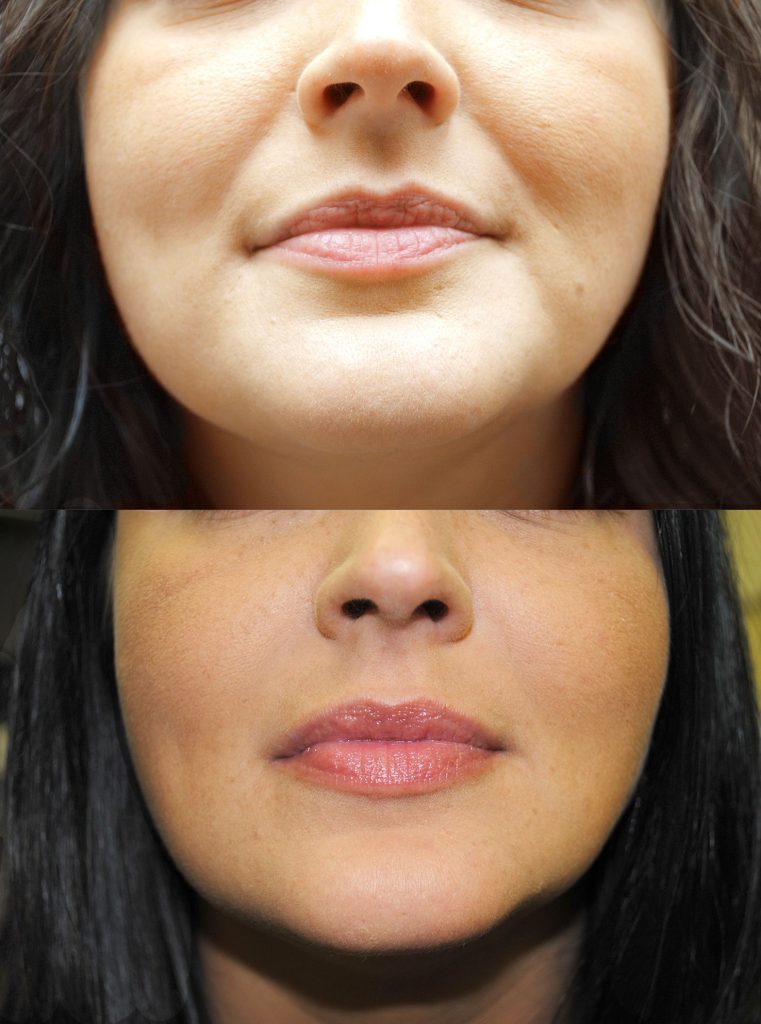 Botox Chin Enhancement: Before & After Results, Costs, and Expert Guide ...