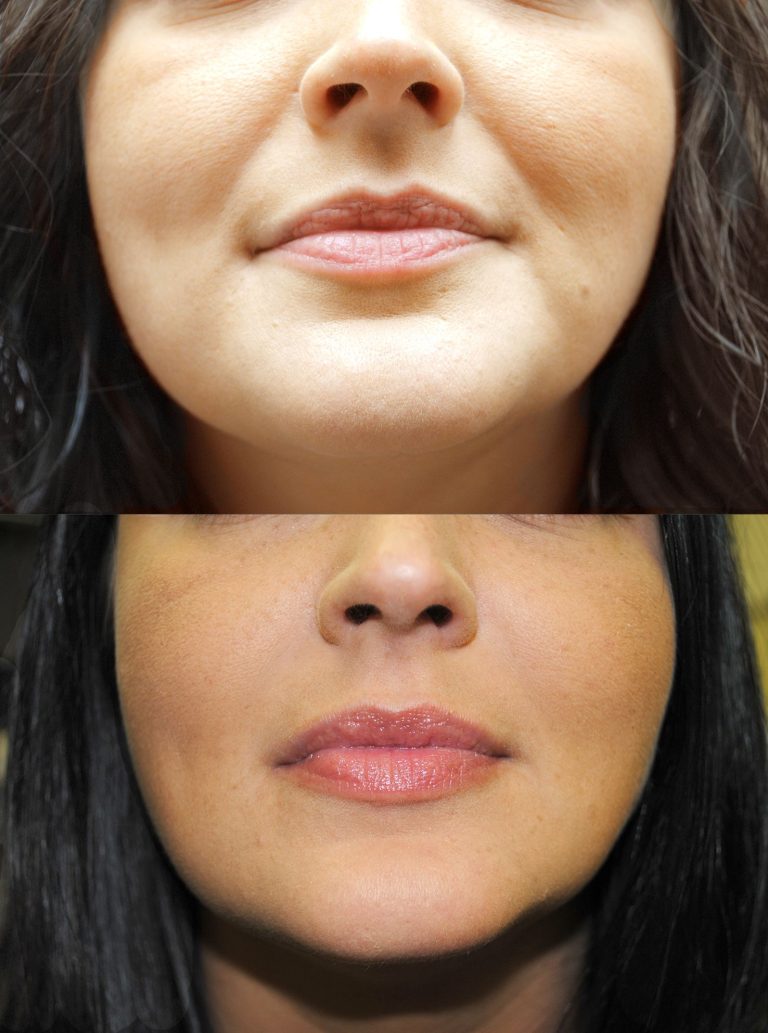 Botox Chin Enhancement: Before & After Results, Costs, and Expert Guide ...