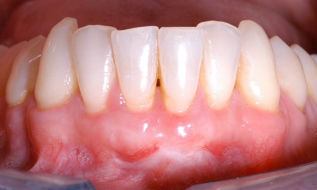Understanding Gum Graft Failure: Signs, Causes, and Solutions - Chaztin