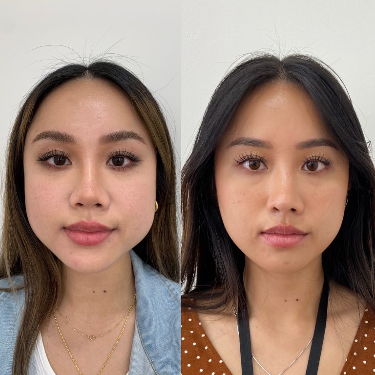 Jaw Botox Before & After: Transformations, Costs, & Real Patient ...