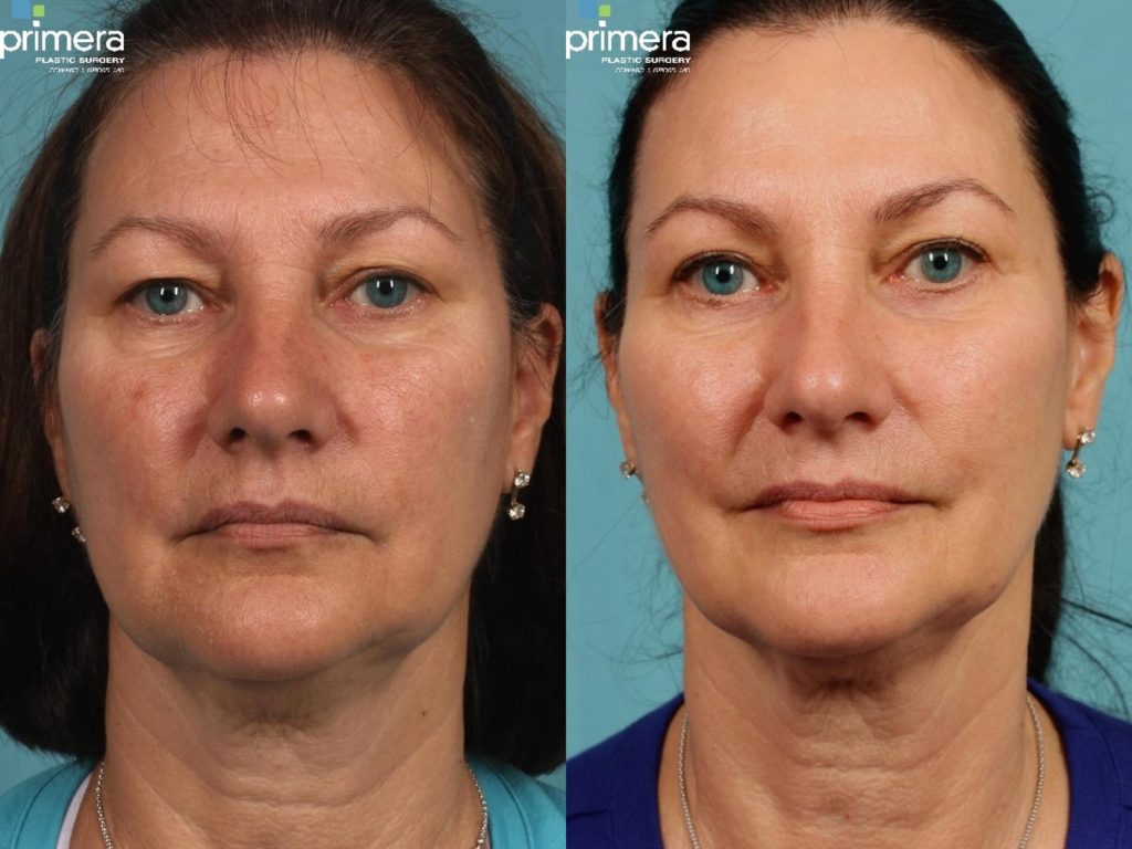 Botox Eyelid Droop: Pictures, Causes, Treatments, and Prevention - Chaztin