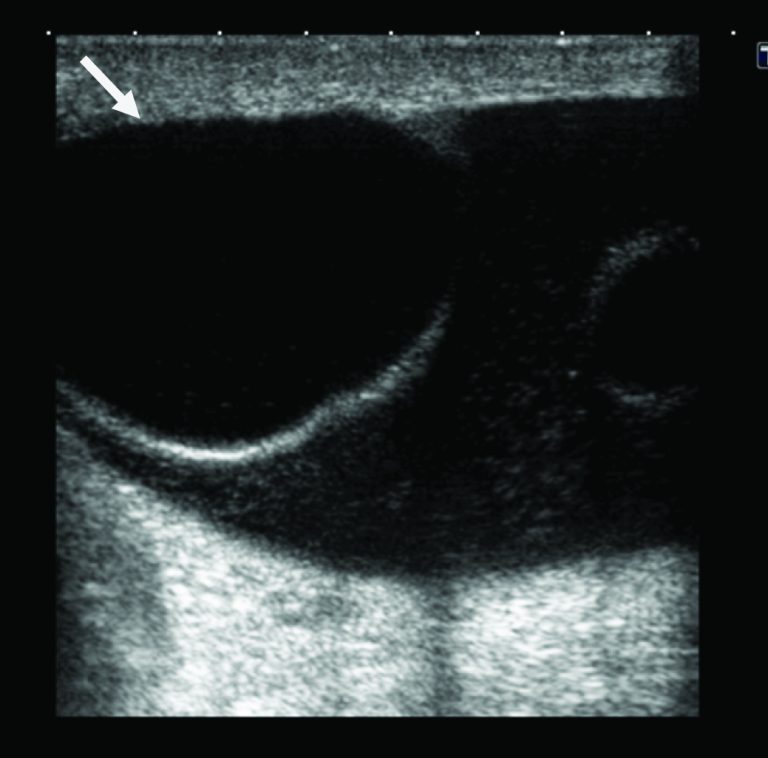 Sebaceous Cysts On The Scrotum Understanding Identifying And