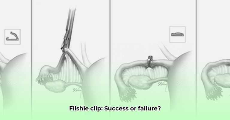 Filshie Clip: Success Rates & Migration Risks - Chaztin